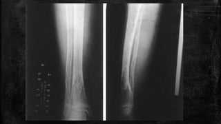 Skeletal dysplasia : Radiodiagnosis | PPTX
