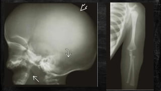 Skeletal dysplasia : Radiodiagnosis | PPTX