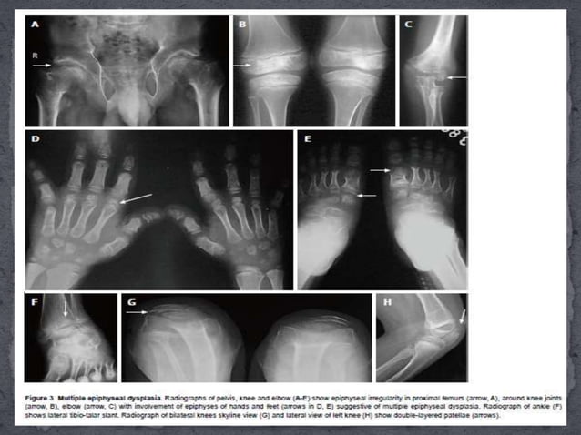 Skeletal dysplasia | PPTX