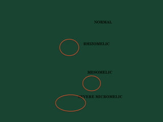 Skeletal dysplasia | PPT