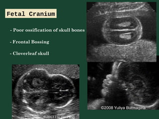 Cloverleaf Skull Ultrasound