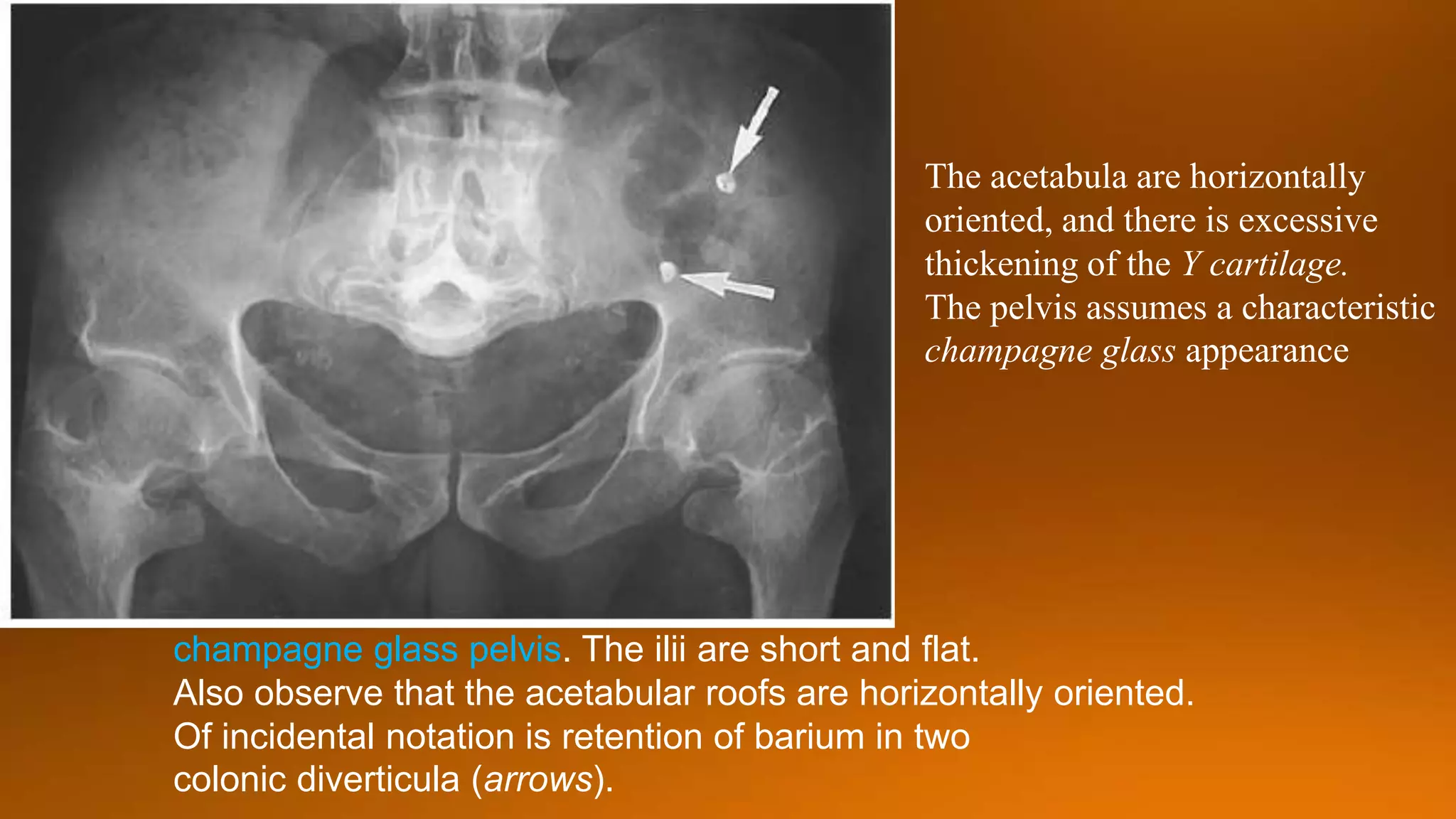 Skeletal dysplasia | PPTX