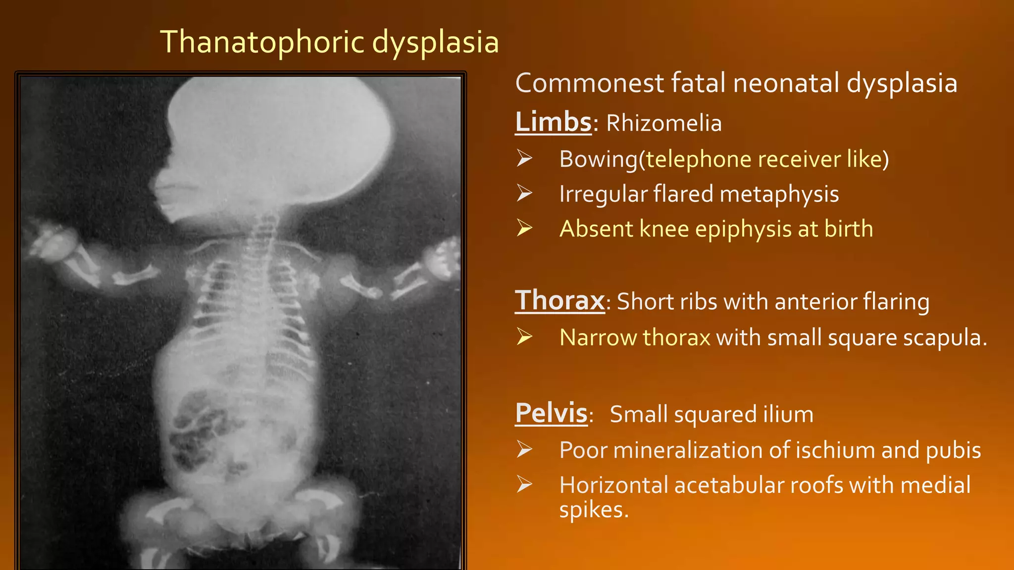 Skeletal dysplasia | PPTX