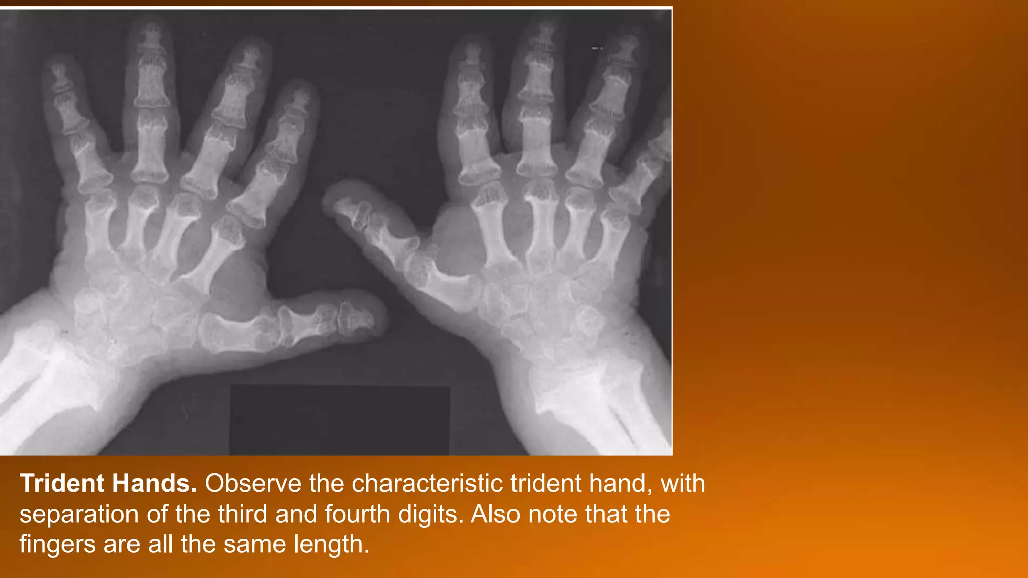Skeletal dysplasia | PPTX