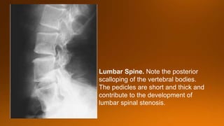 Skeletal dysplasia | PPTX