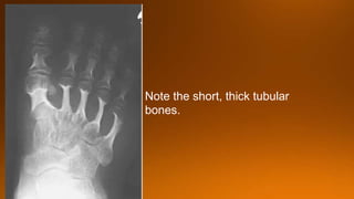 Skeletal dysplasia | PPTX