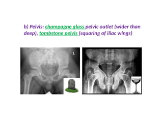 SKELETAL-DYSPLASIA- AND-ALL-ITS-TYPES. | PPTX