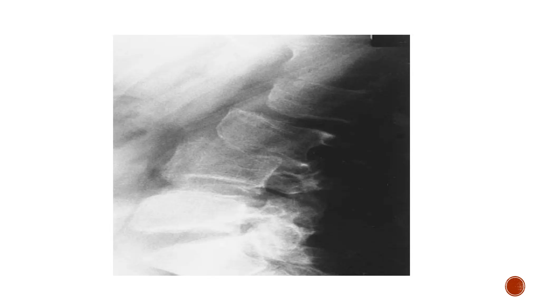 IMAGING IN SKELETAL DYSPLASIA - classification .pptx