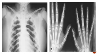 IMAGING IN SKELETAL DYSPLASIA - classification .pptx