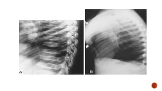 IMAGING IN SKELETAL DYSPLASIA - classification .pptx