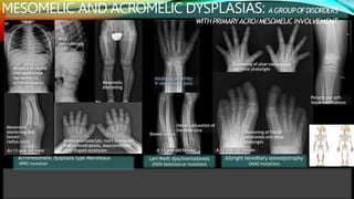 Imaging in skeletal dysplasia based on families | PPTX