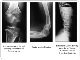 Skeletal dysplasia final | PPTX