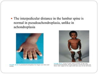 Skeletal dysplasia final | PPTX