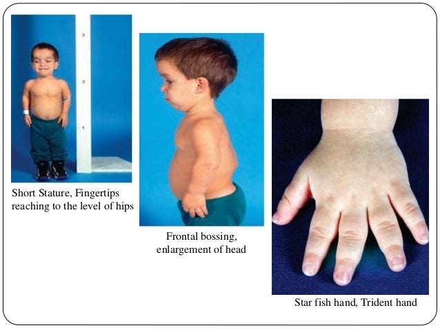 Skeletal dysplasia final