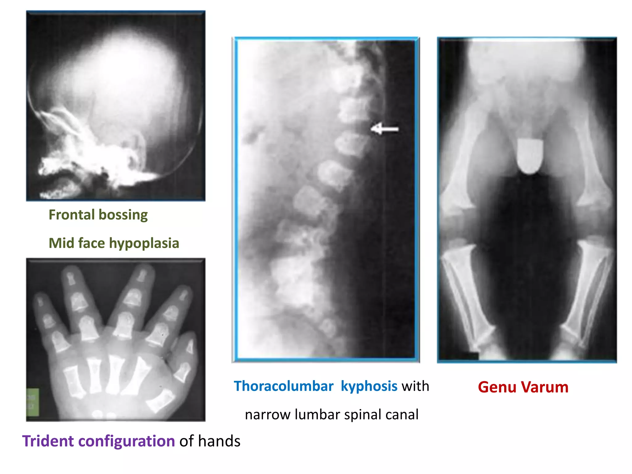 Skeletal dysplasias and dwarfism | PPTX
