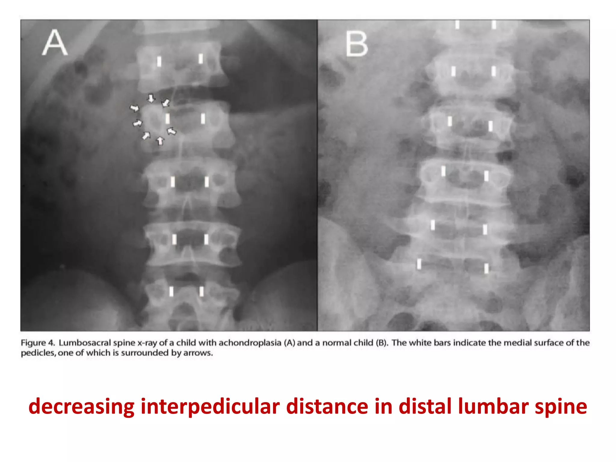 Skeletal dysplasias and dwarfism | PPTX