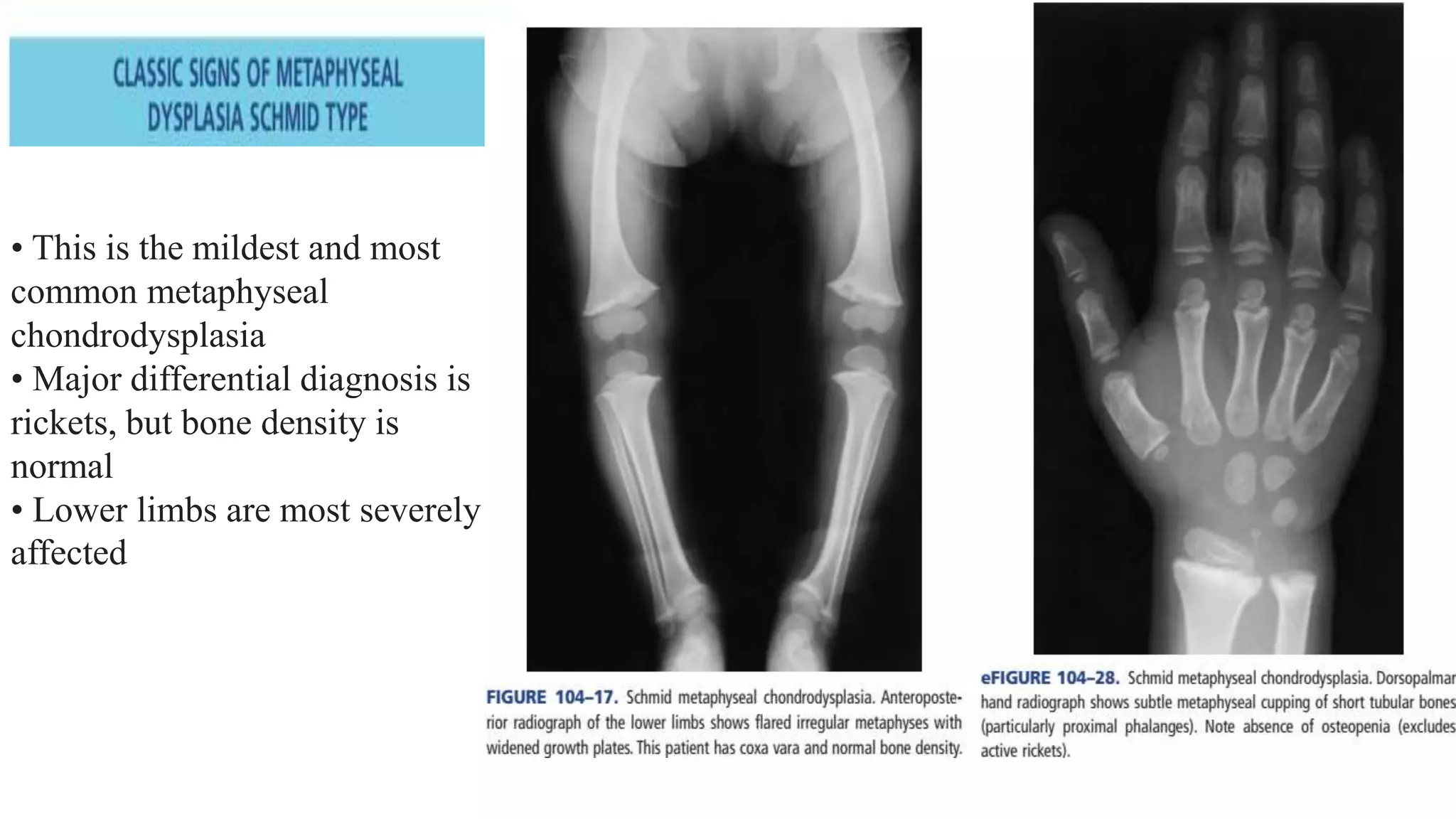 Skeletal dysplasia musculoskeletal radiology | PPTX