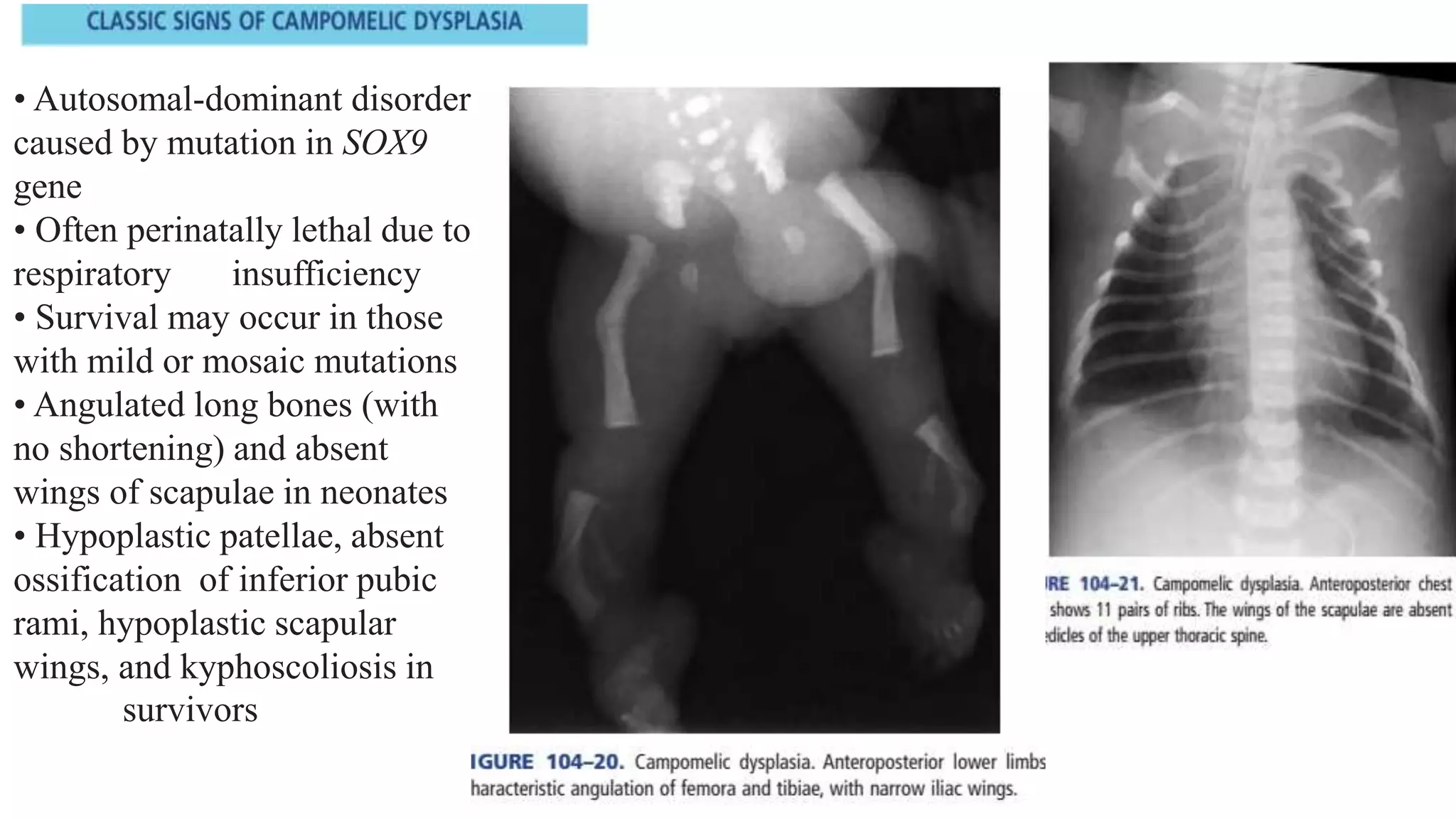 Skeletal dysplasia musculoskeletal radiology | PPTX