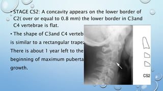 Skeletal maturation evaluation using cervical vertebrae | PPTX