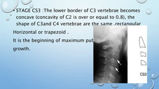 Skeletal maturation evaluation using cervical vertebrae | PPTX