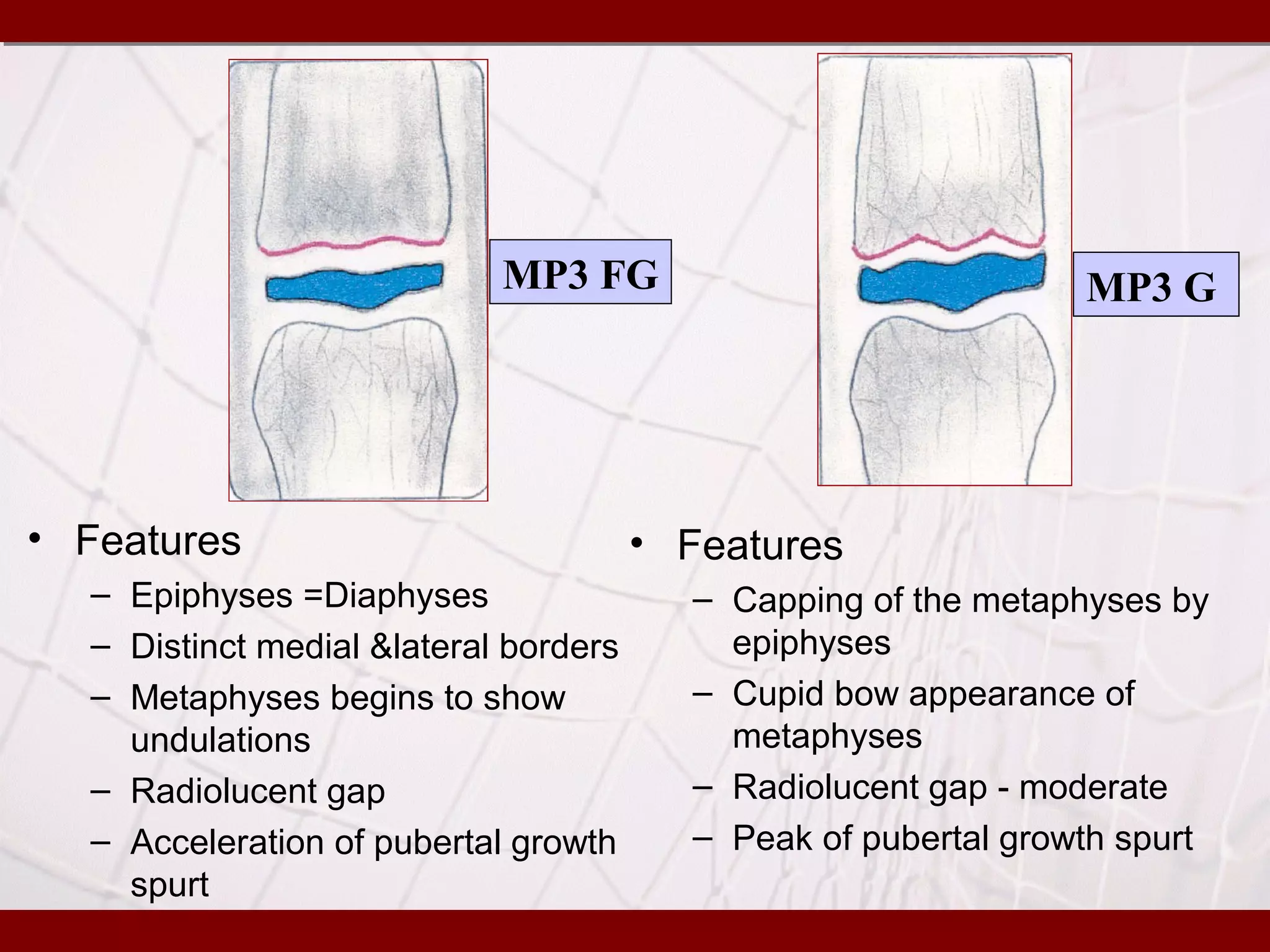 Skeletal maturity indicators | PPT