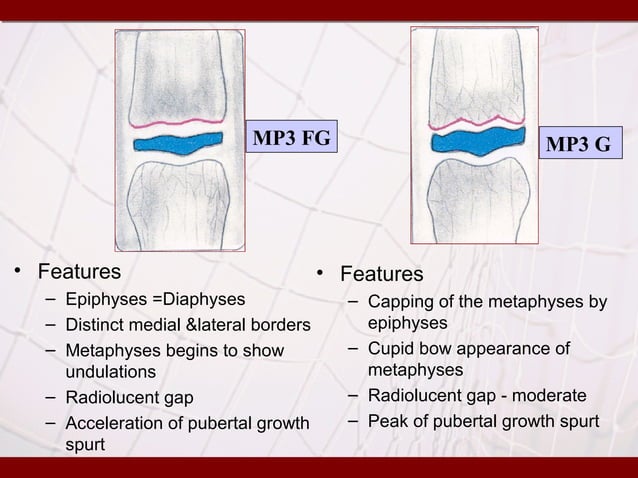 Skeletal maturity indicators | PPT