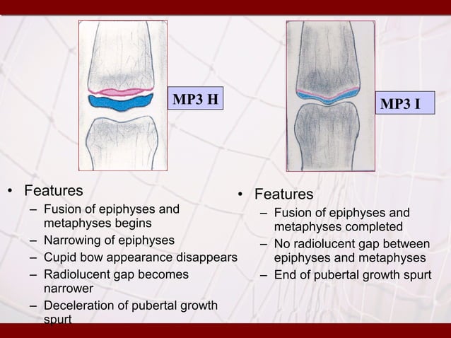 Skeletal maturity indicators | PPT