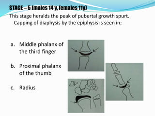 Skeletal maturity index | PPTX