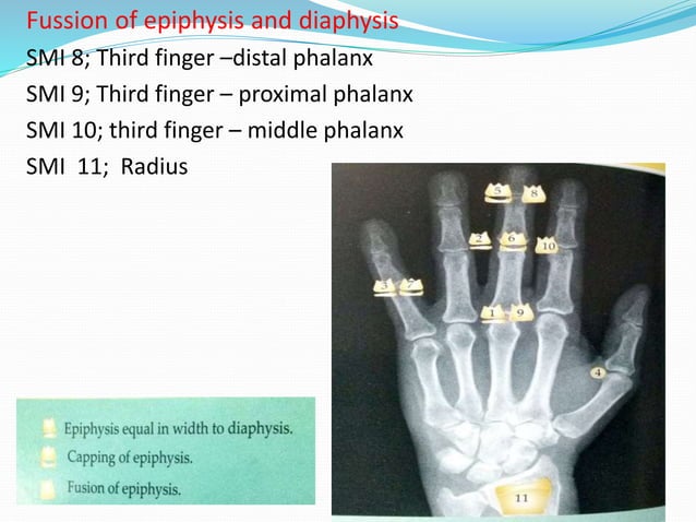 Skeletal maturity index | PPTX | Menopause | Endocrine and Metabolic ...