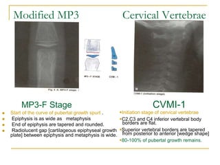 Skeletal Maturity Indicator | PPT