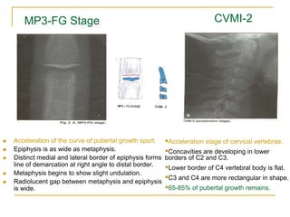 Skeletal Maturity Indicator | PPT