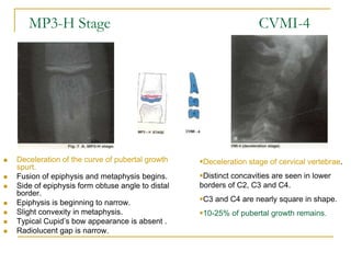 Skeletal Maturity Indicator | PPT