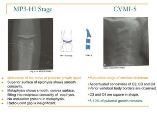 Skeletal Maturity Indicator | PPT