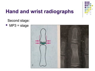 presentation on skeletal maturity indicator.ppt