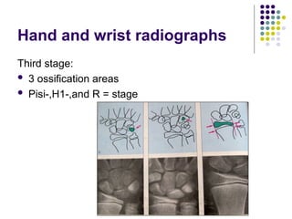 presentation on skeletal maturity indicator.ppt