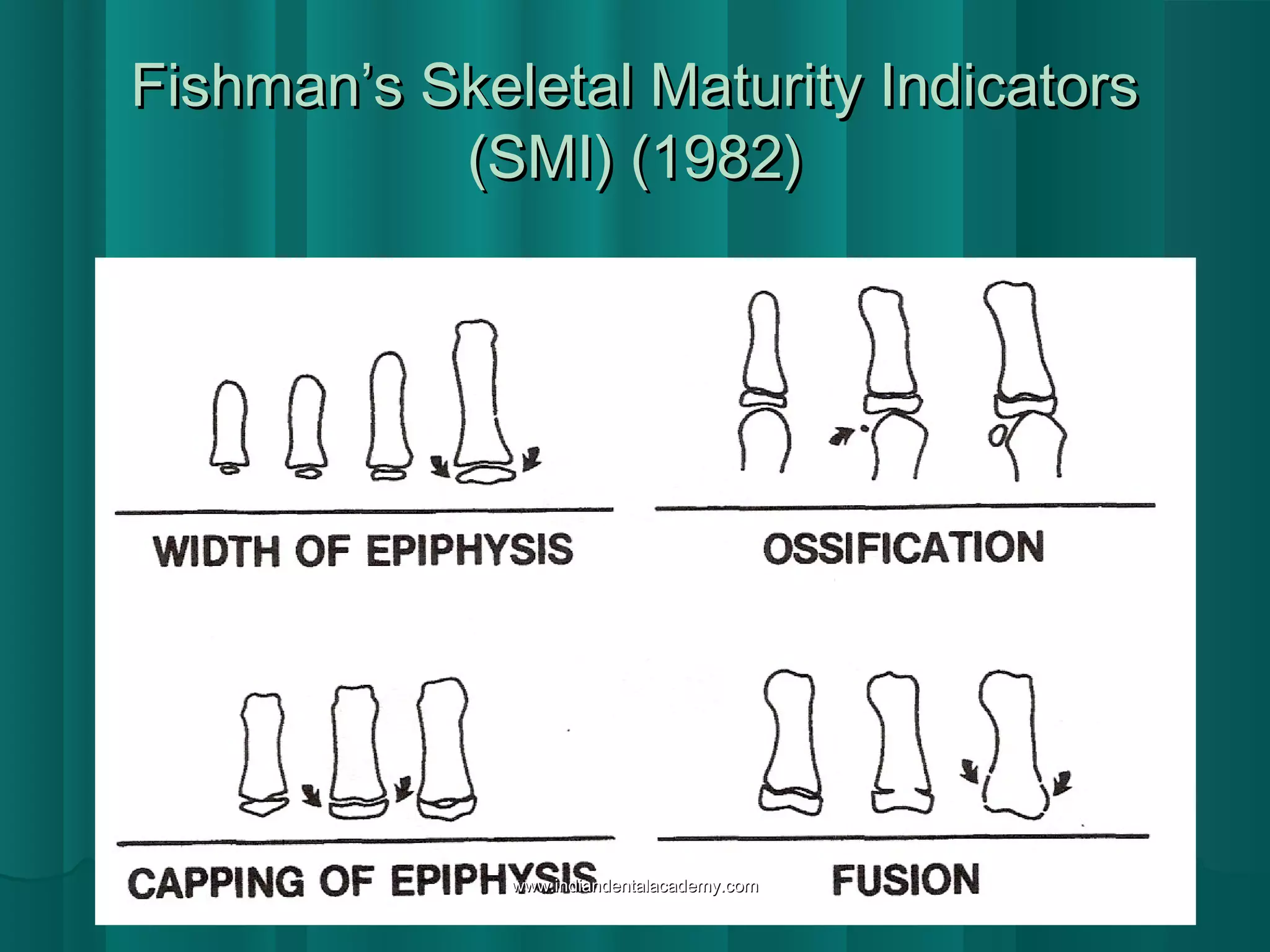 Skeletal maturity indicators/endodontic courses | PPT