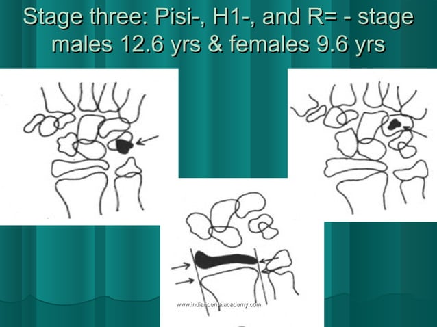 Skeletal maturity indicators/endodontic courses | PPT | Bone and Joint ...