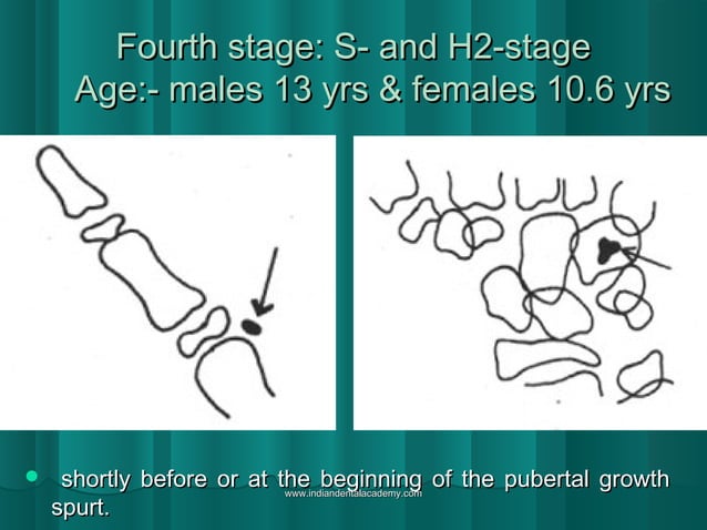 Skeletal maturity indicators/endodontic courses | PPT | Bone and Joint ...