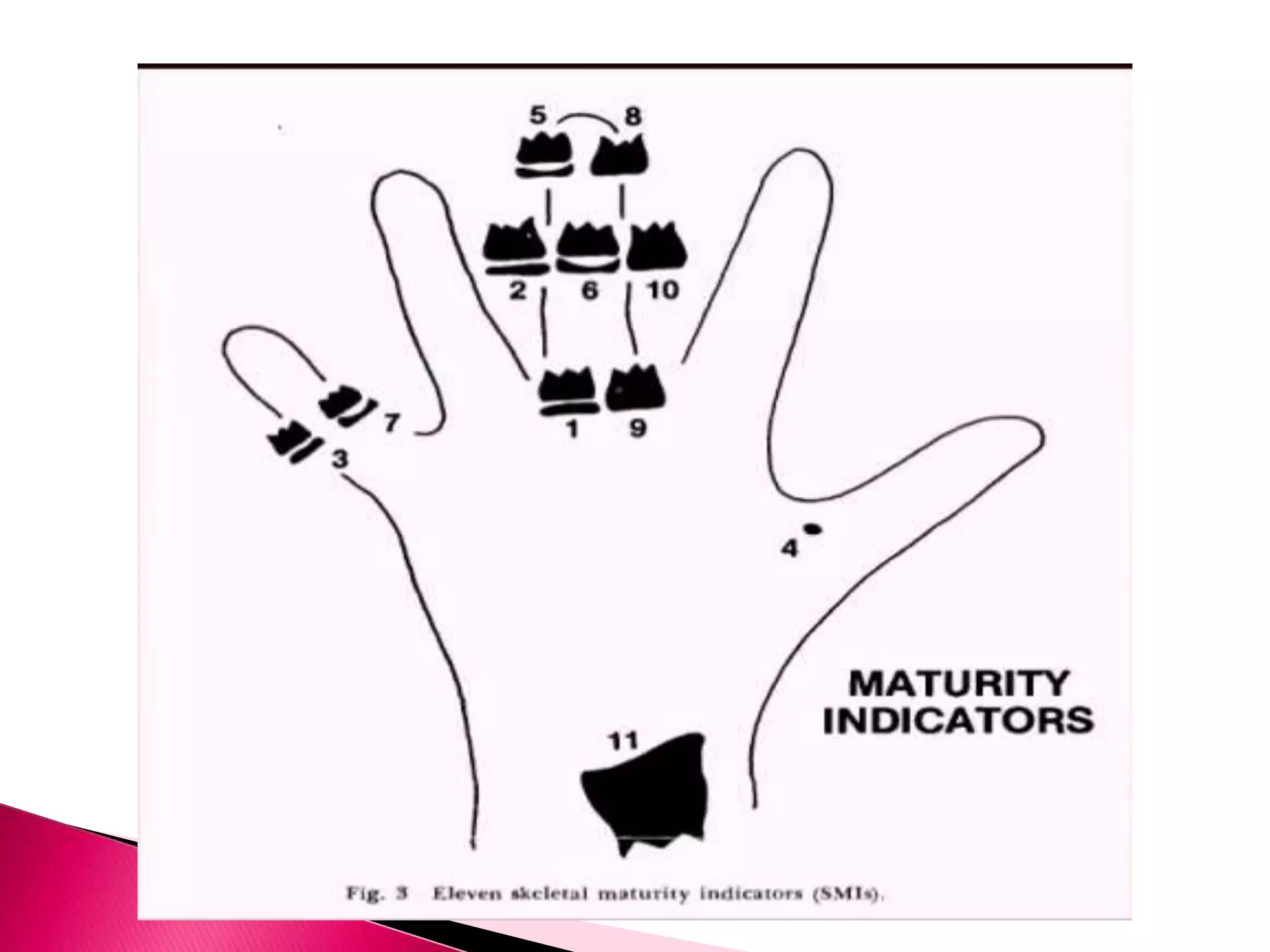 Skeletal maturity indicators | PPTX