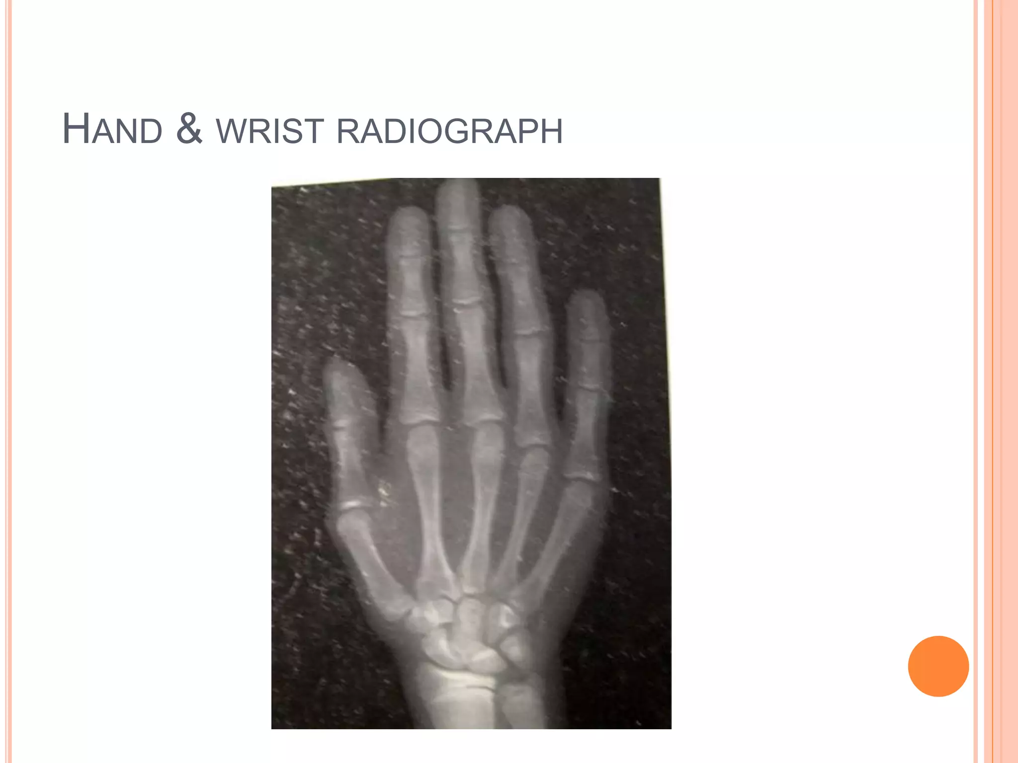 Skeletal maturity indicators | PPTX