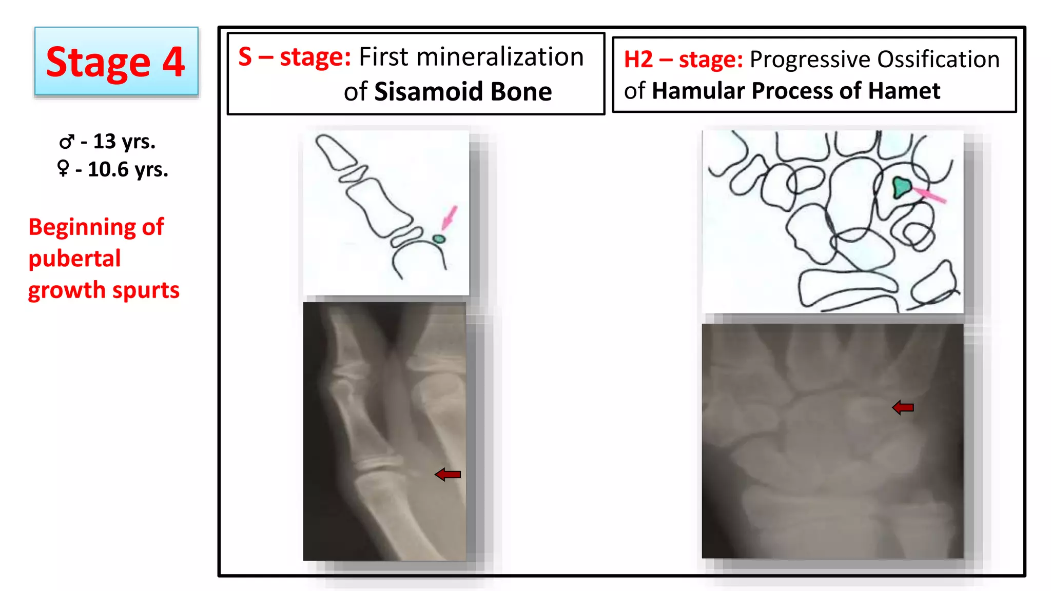 Skeletal maturity indicator short | PPTX