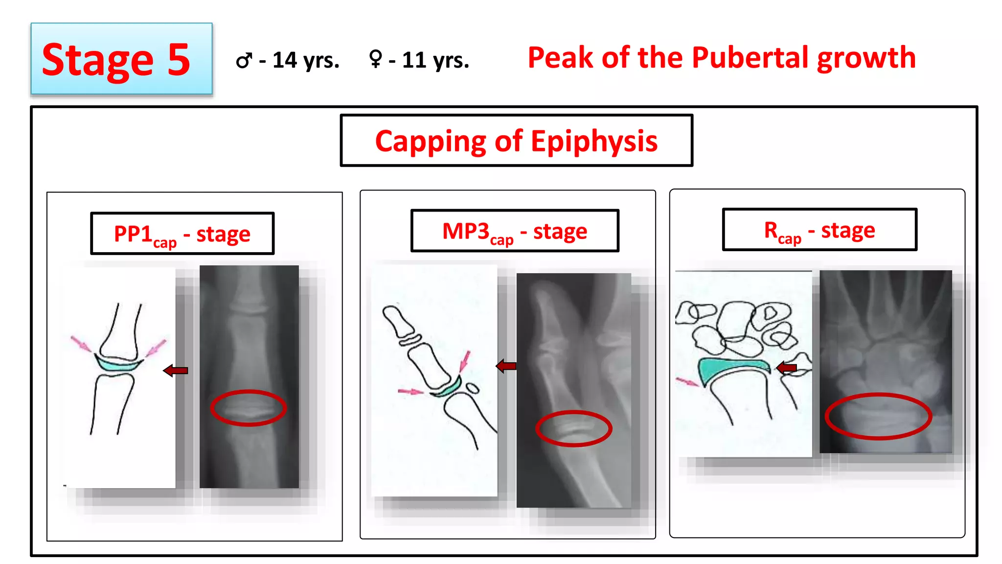 Skeletal Maturity Indicator Short Pptx