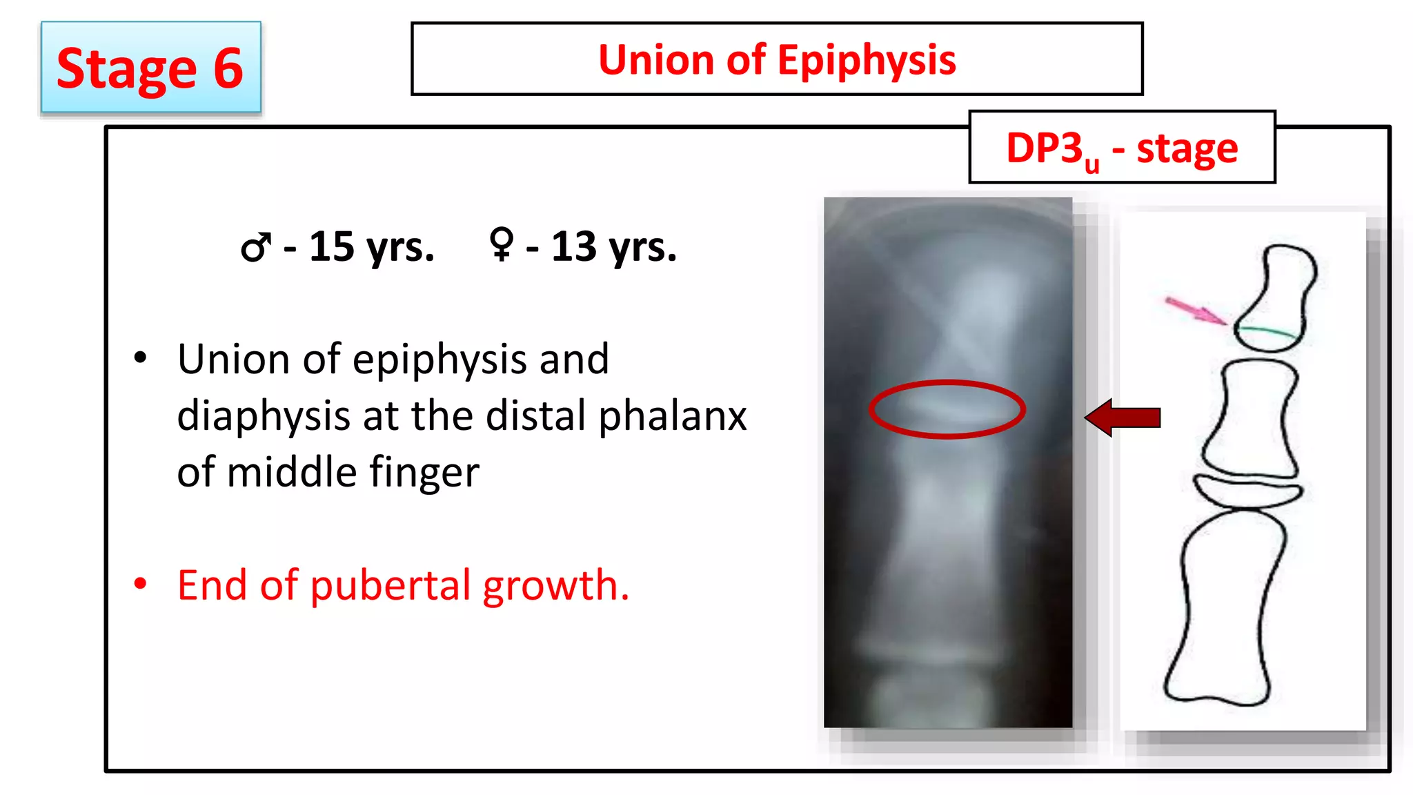 Skeletal Maturity Indicator Short Pptx