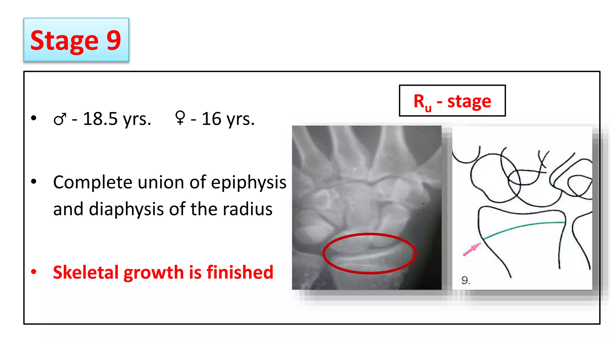 Skeletal maturity indicator short | PPTX