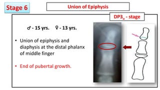Skeletal maturity indicator short | PPTX