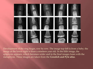 Skeletal Maturity indicators O.pptx
