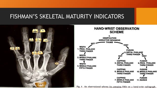 Skeletal maturity indicators | PPTX