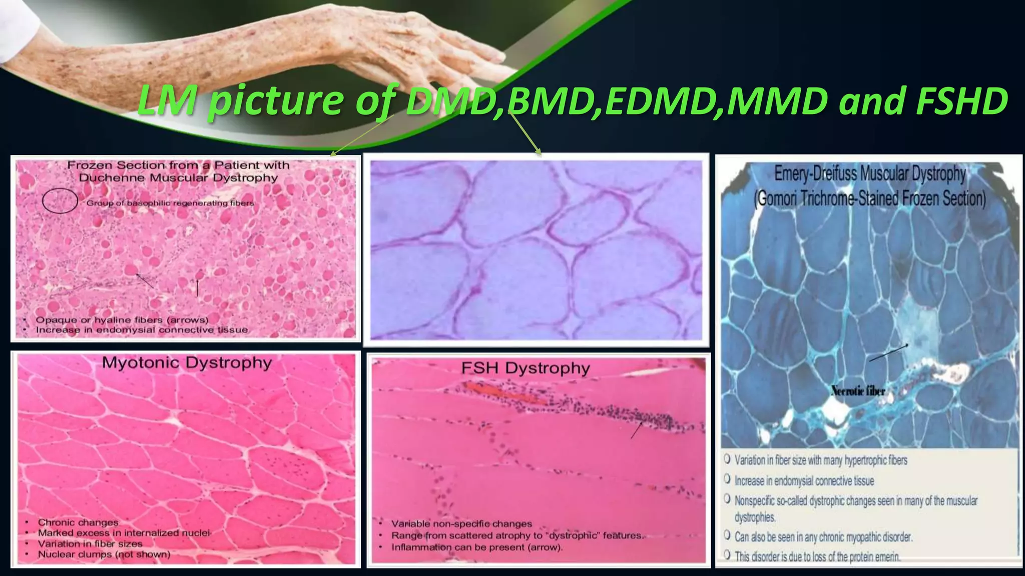 Skeletal muscles diseases | PPTX
