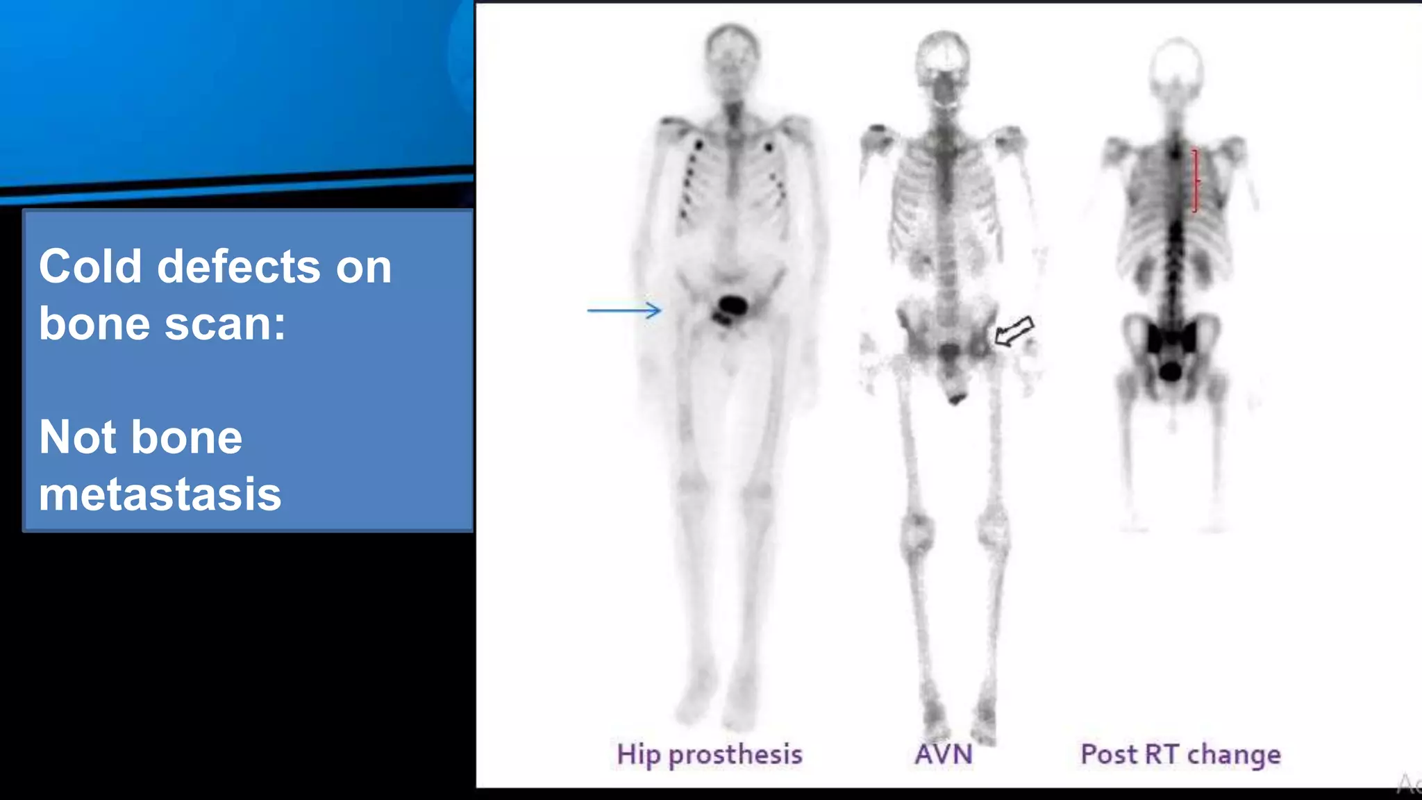 Skeletal scintigraphy presenatation, dr.mustafa | PPT
