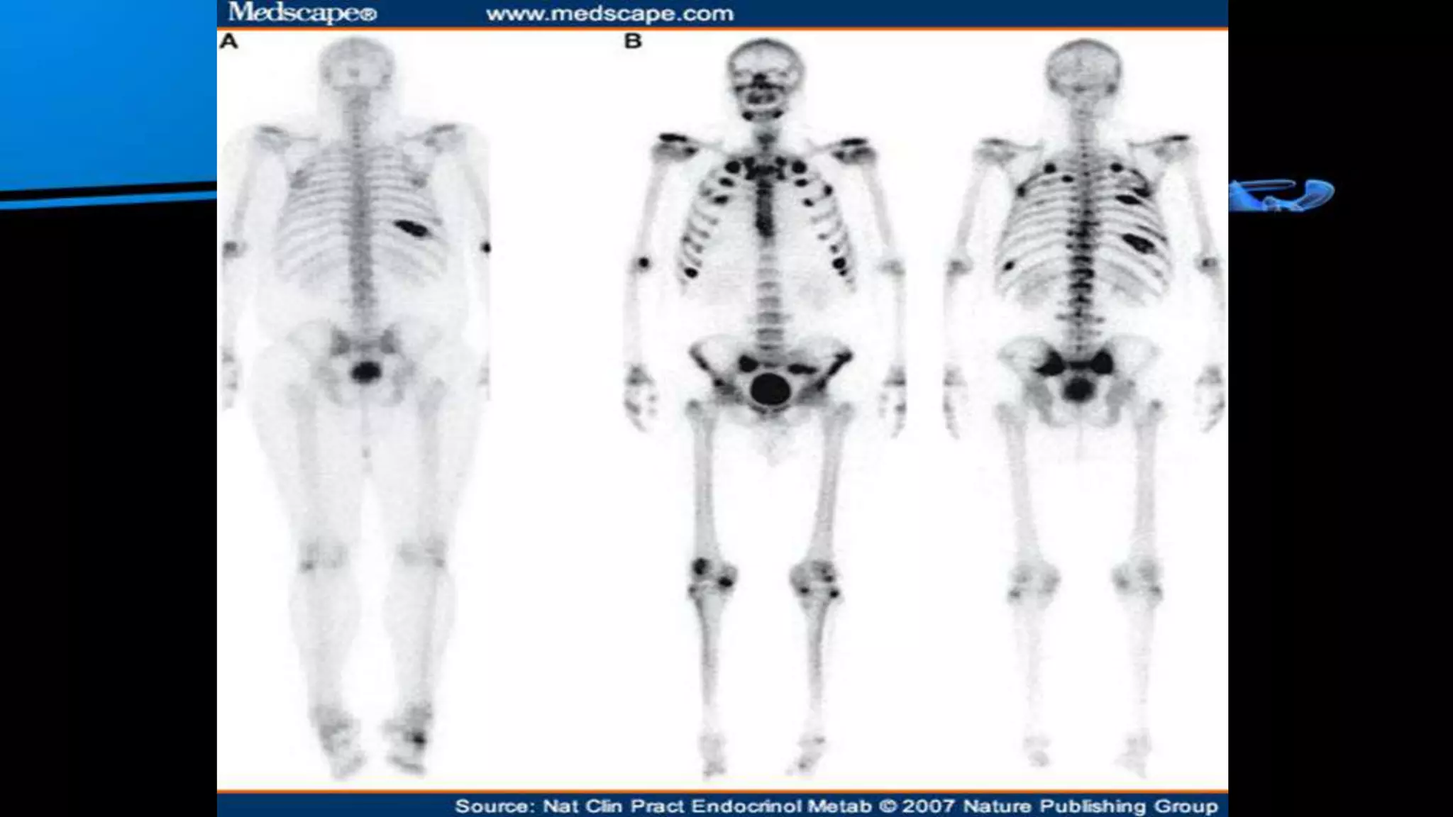 Skeletal scintigraphy presenatation, dr.mustafa | PPTX